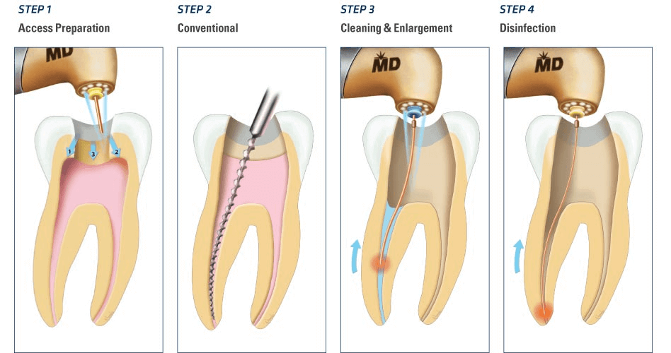 Laser Dentist Ahmedabad, Painless Laser Dentistry in Ahmedabad Laser Dentist Ahmedabad, Painless Laser Dentistry in Ahmedabad